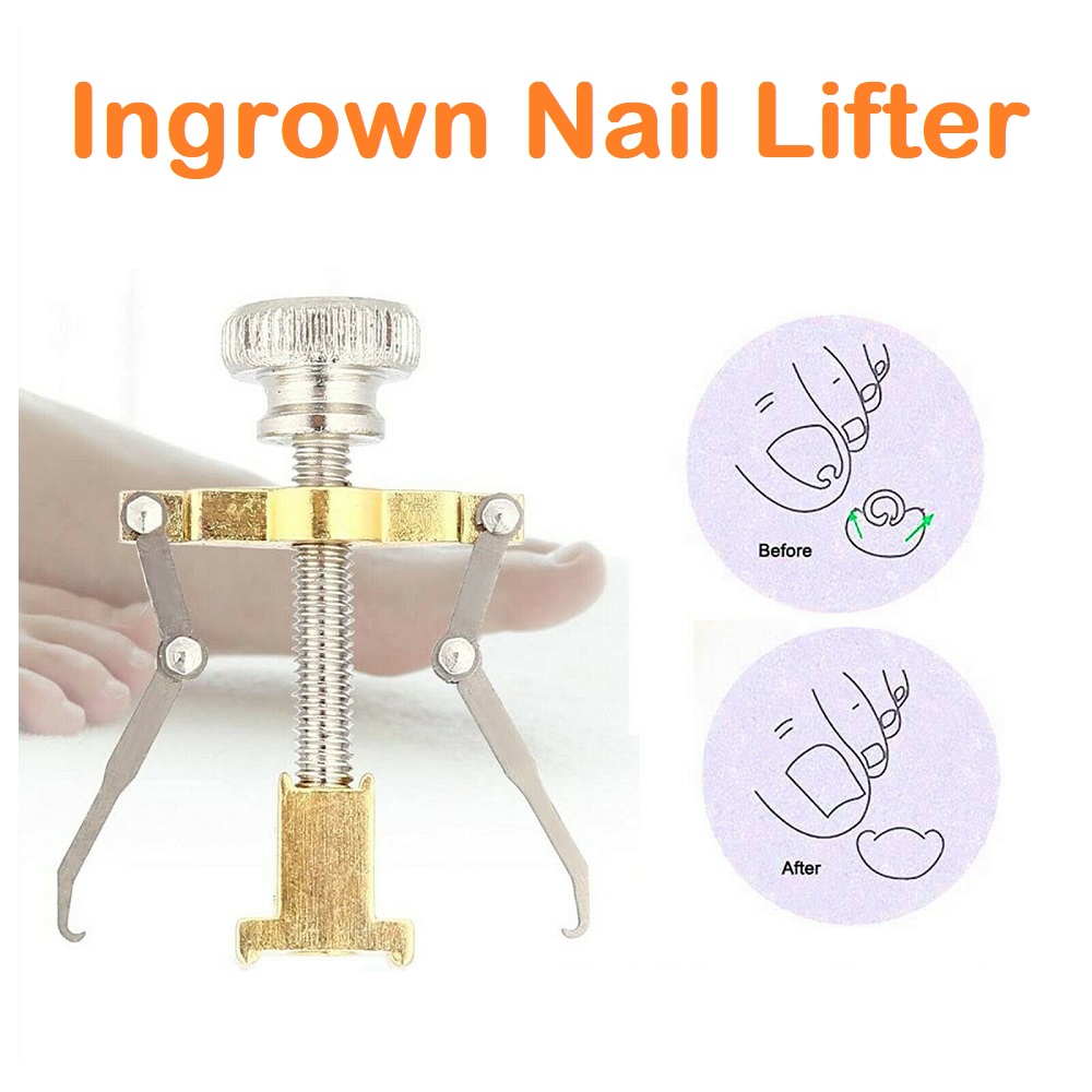 Ingrown Nail Correction Lifter | Property Room